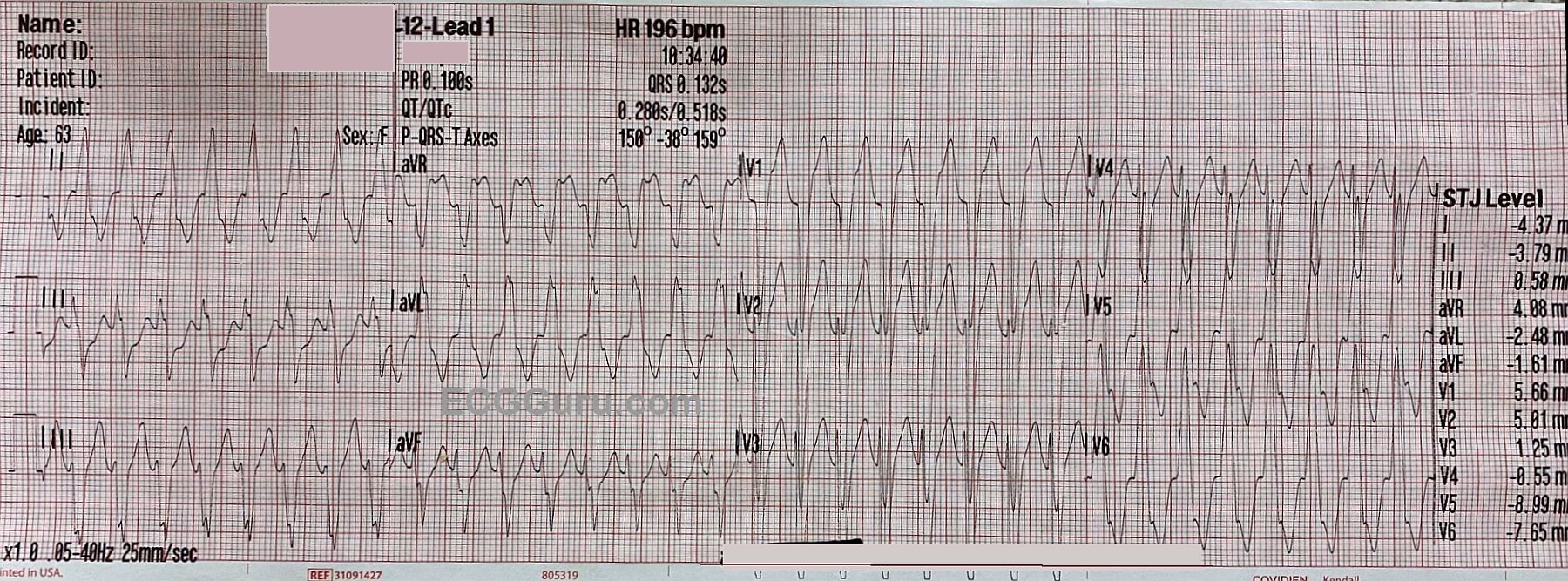 Wide Complex Tachycardia Ecg Guru Instructor Resources